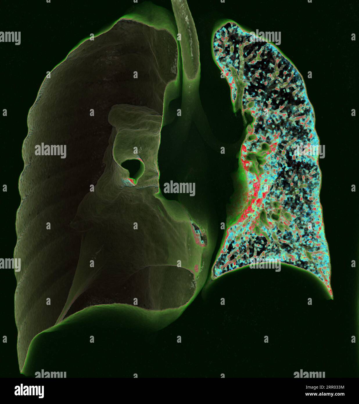 Tension pneumothorax, CT scan Stock Photo - Alamy