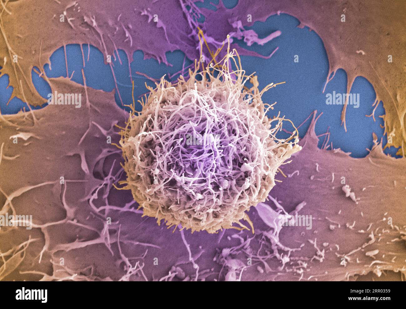 Cervical cancer cells, SEM Stock Photo - Alamy