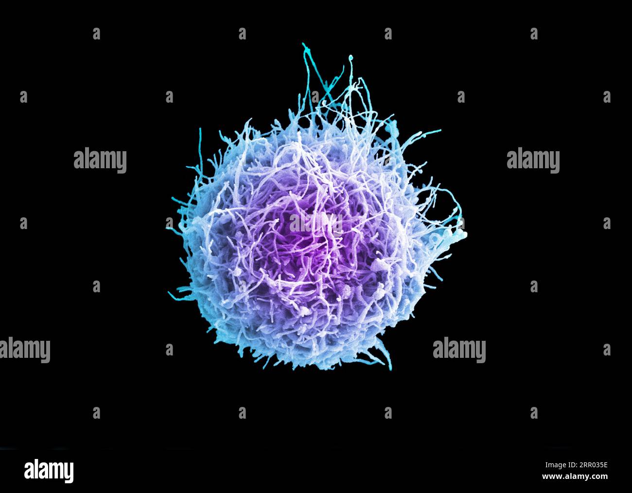 Cervical cancer cell, SEM Stock Photo - Alamy