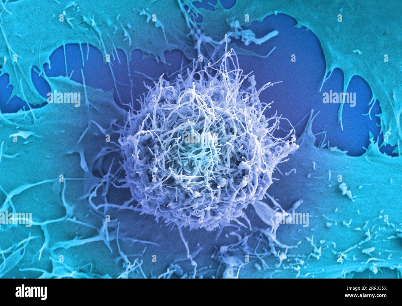 Cervical cancer cells, SEM Stock Photo - Alamy