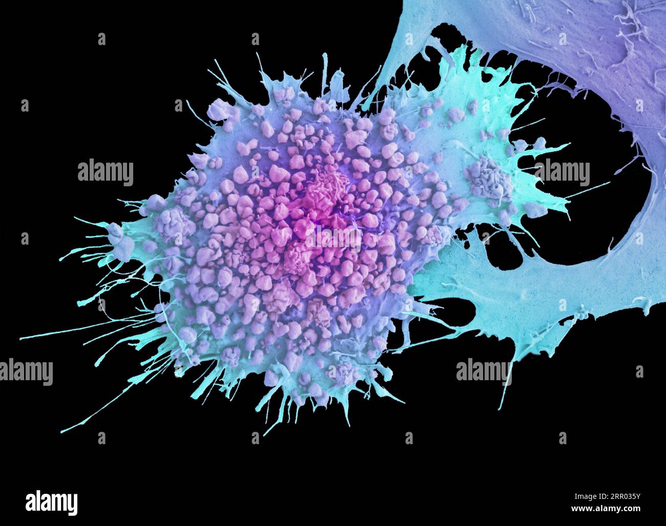 Cervical cancer cells, SEM Stock Photo - Alamy