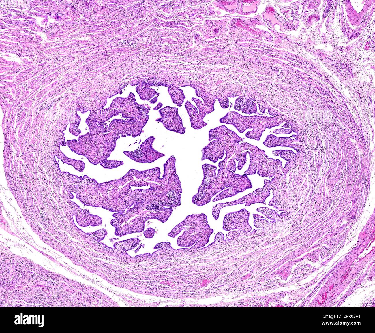 Salpingitis, light micrograph Stock Photo - Alamy