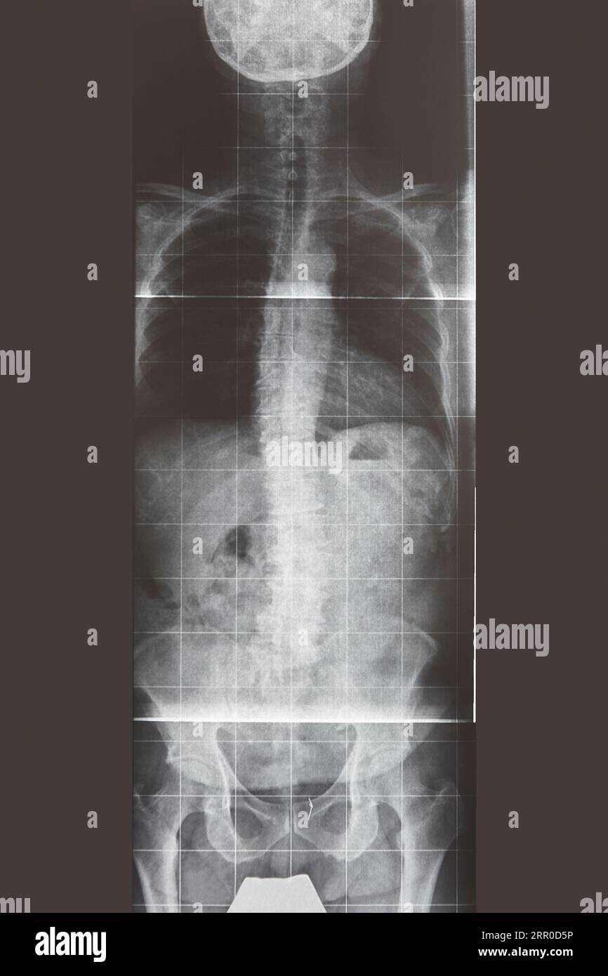 Lumbar spine xray. Front view. Healthcare. Image diagnosis Stock Photo ...