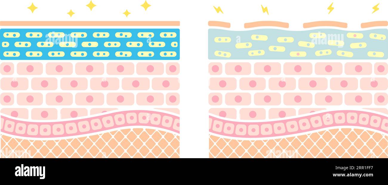 Comparison Illustration Of Healthy Skin And Dry Skin Cross Section Of