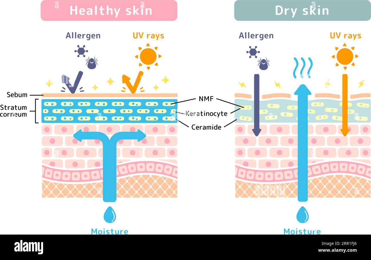 Comparison illustration of healthy skin and dry skin (cross section of ...