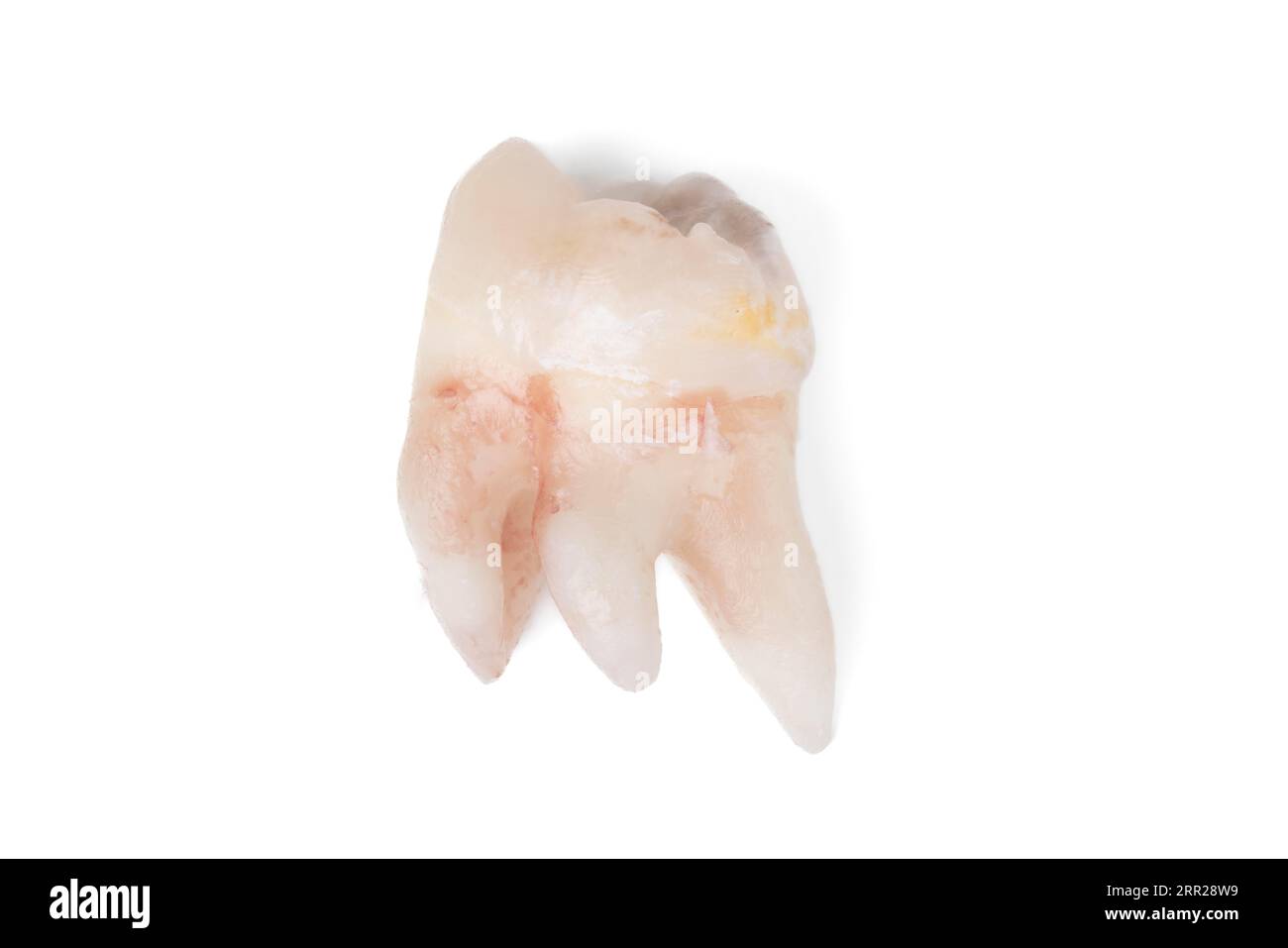 Pulled wisdom tooth, tooth, carious, damaged, white background Stock ...