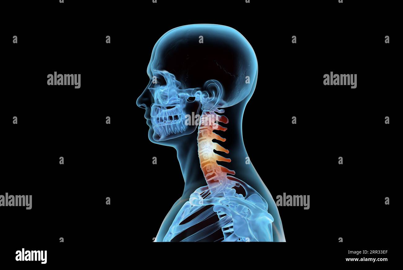 Side view of cervical section of spine injury and pain on black ...