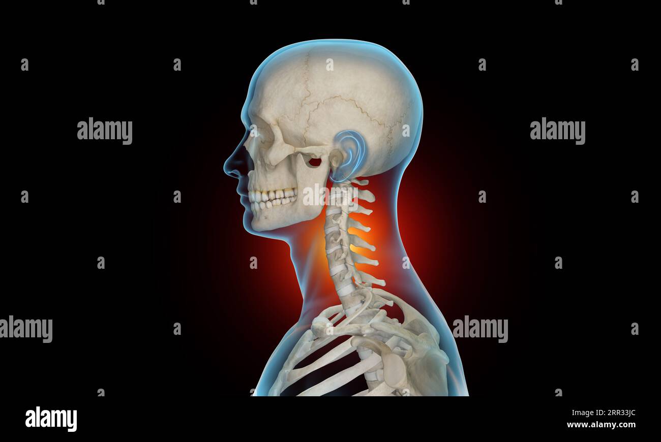 Side view of cervical section of spine injury and pain on black ...