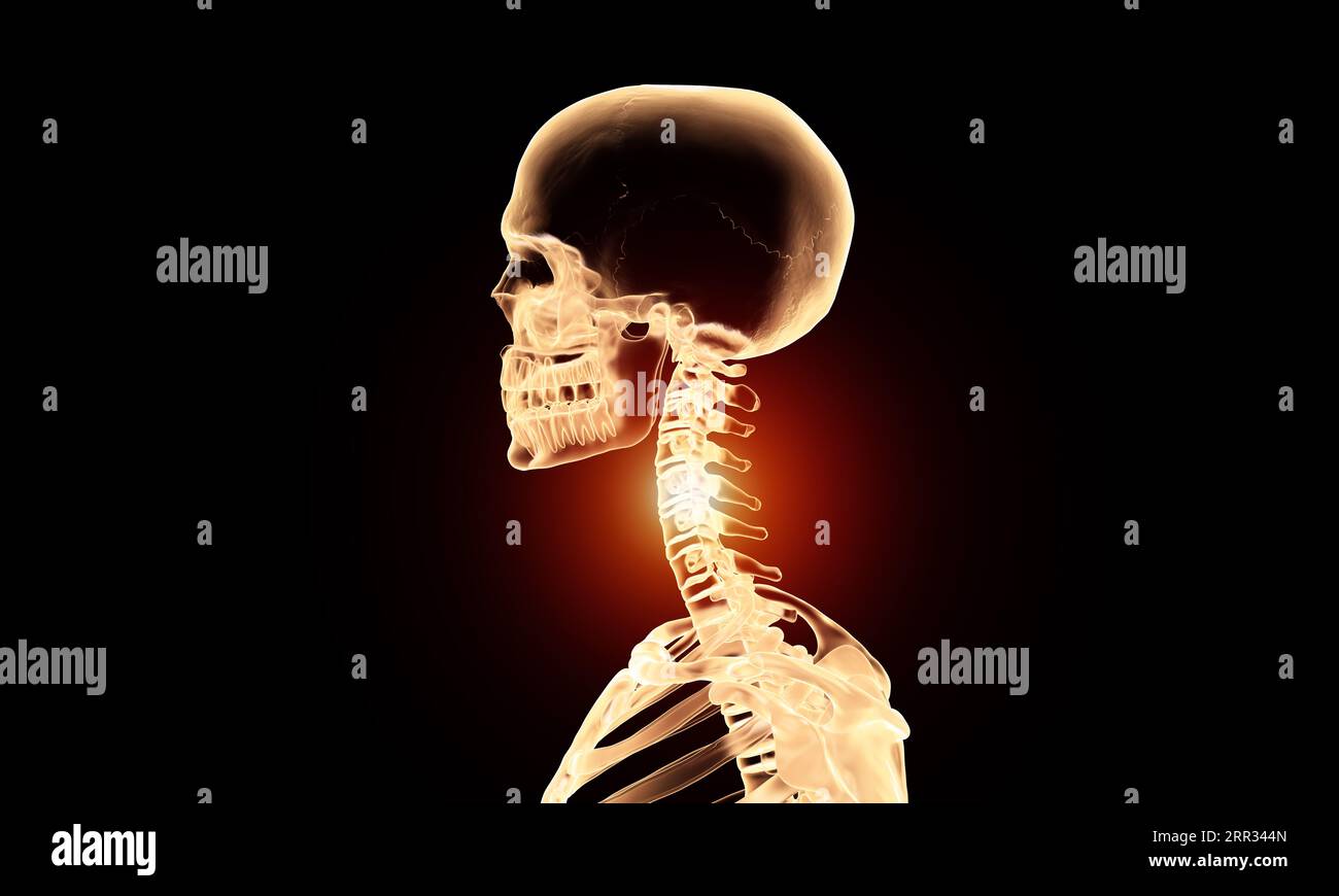 neck skeleton x-ray with cervical pain injury on black background Stock ...