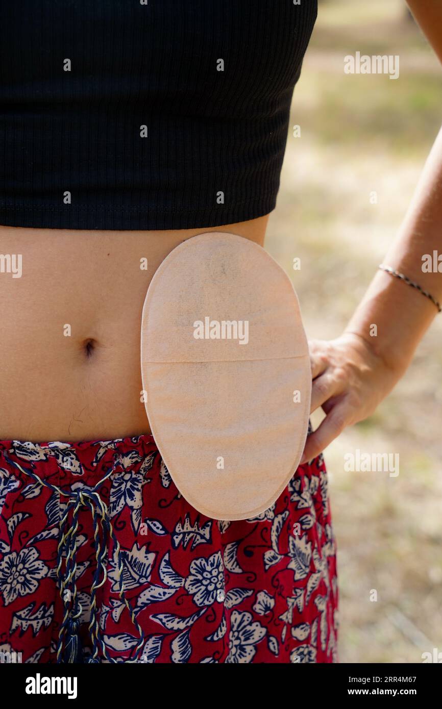 ostomy bag in the nature. Cancer colon survivor with an Intestine ...