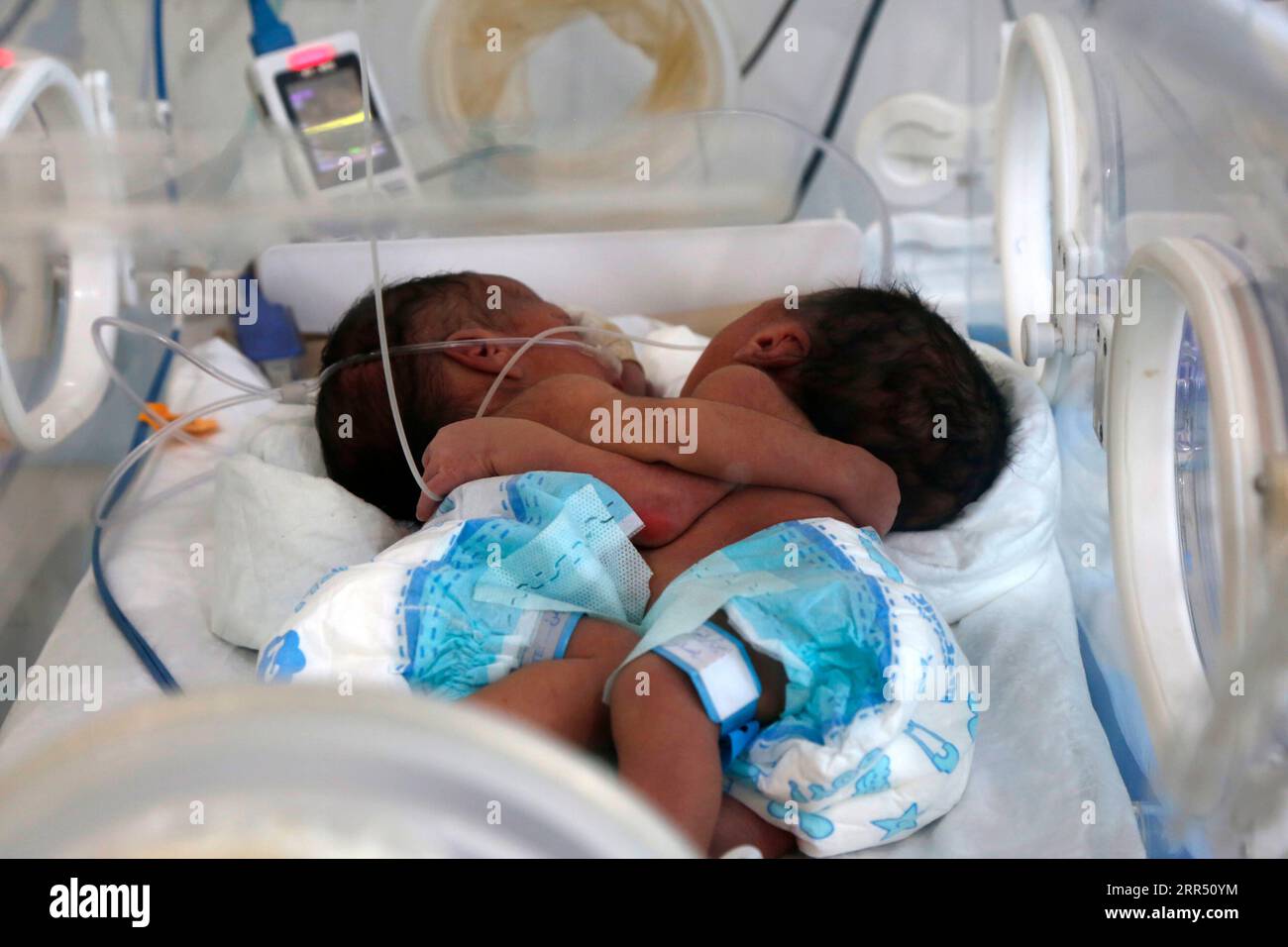 Conjoined twins born hi-res stock photography and images - Alamy