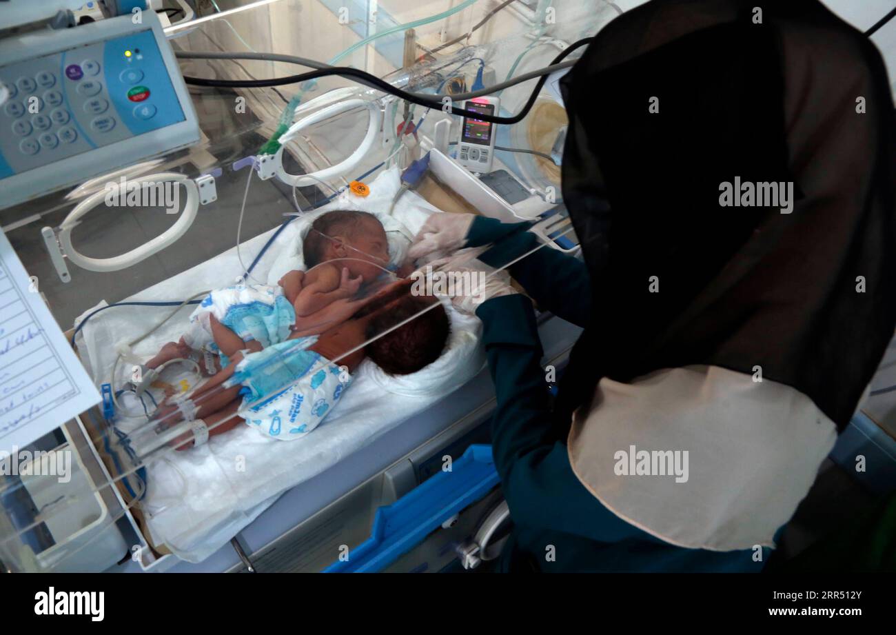 Conjoined twins born hi-res stock photography and images - Alamy