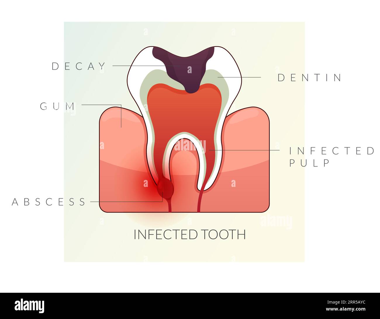 Infected Teeth - Root Canal Treatment - Stock Illustration as EPS 10 ...