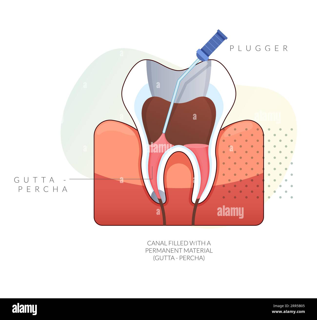 Infected Teeth - Root Canal Treatment - Stock Illustration as EPS 10 ...