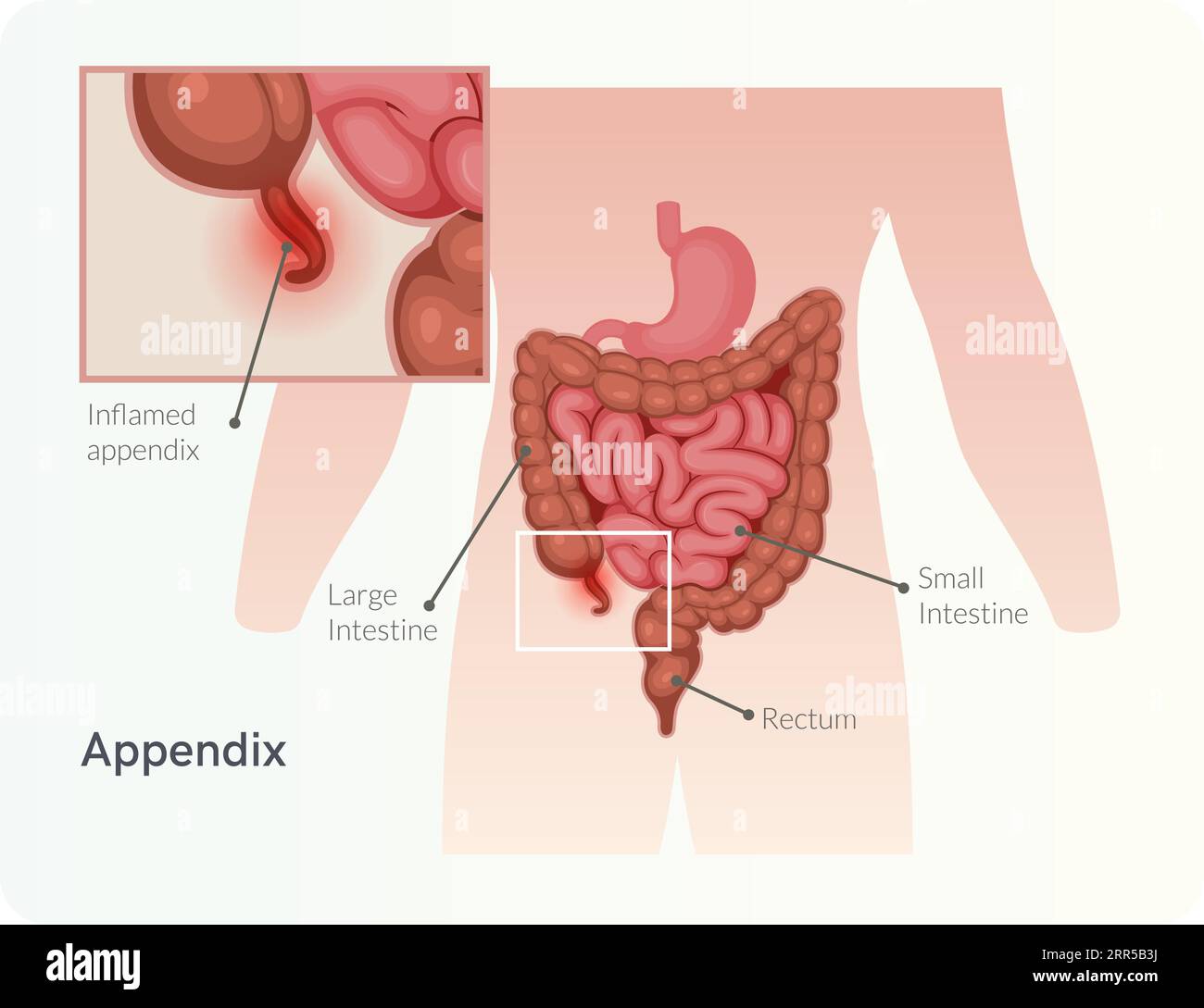 Inflamed Appendix