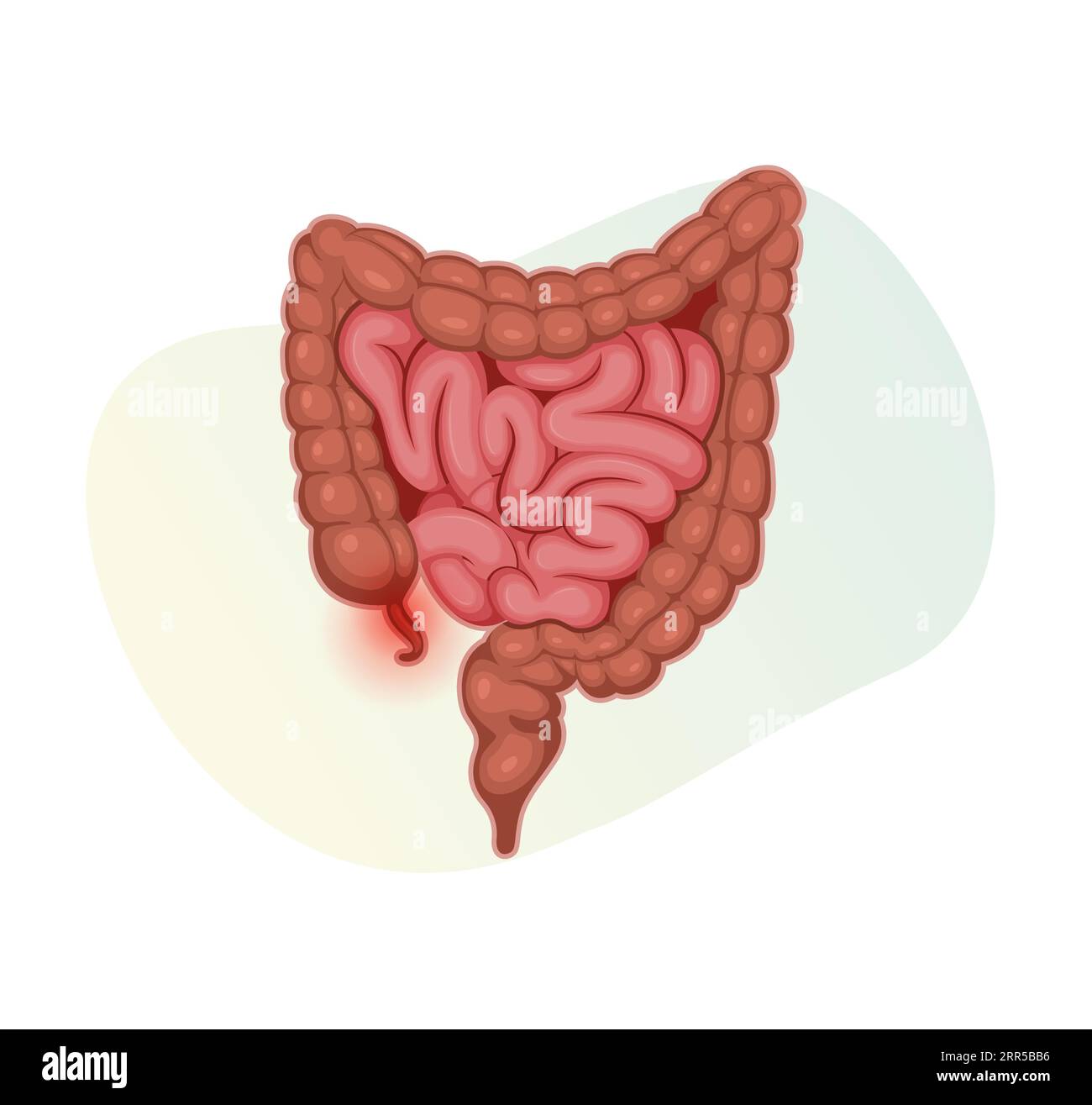 Appendicitis Inflamed Appendix Stock Illustration As Eps 10 File
