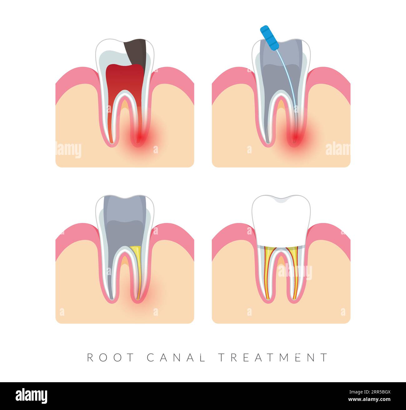 Dental Procedure - Root Canal Treatment - Stock Illustration as EPS 10 ...