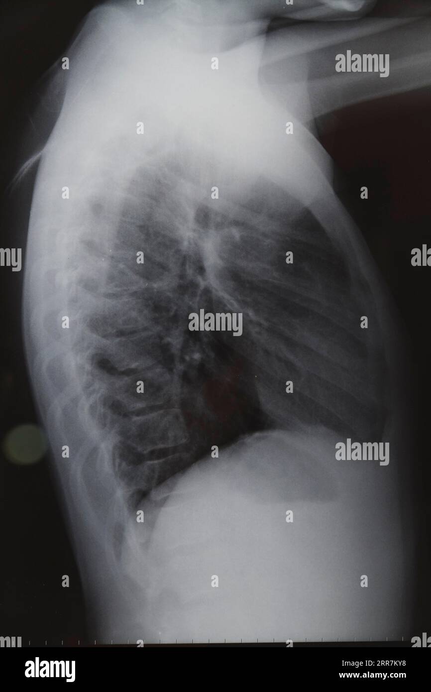 X ray scan back Stock Photo - Alamy