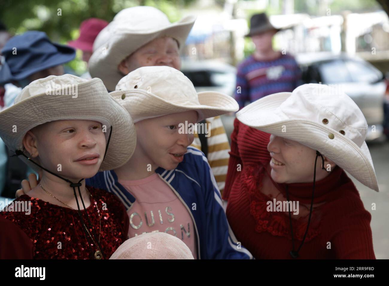 Albinism awareness day hi-res stock photography and images - Alamy