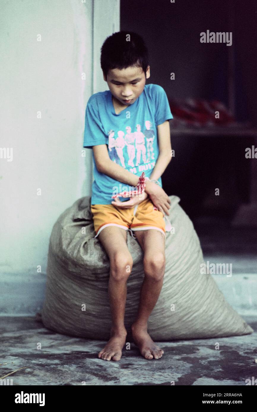 Portrait of a young child suffering from birth defects due to agent ...