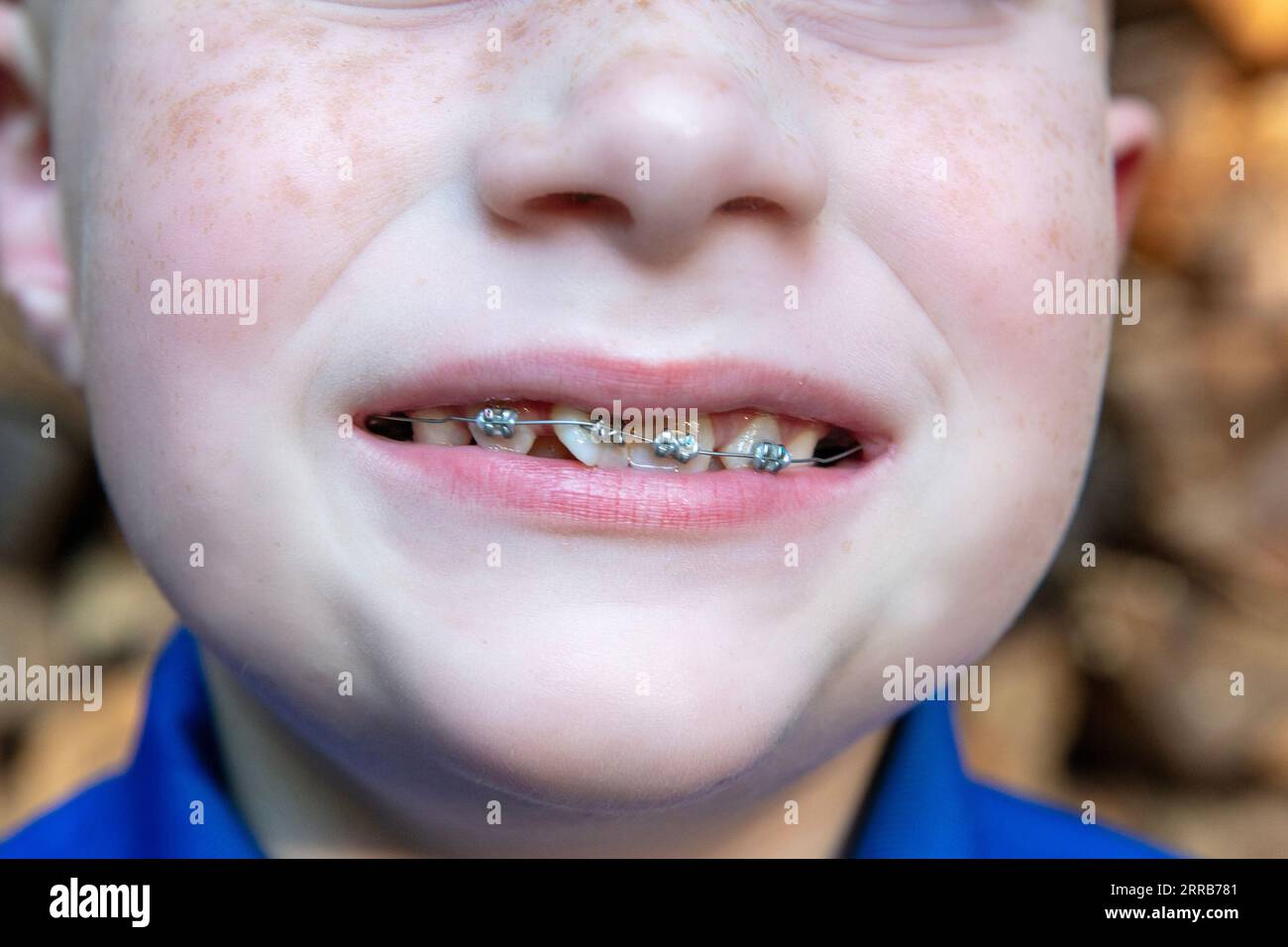 Close-up of a smiling young boy with teeth braces Stock Photo - Alamy