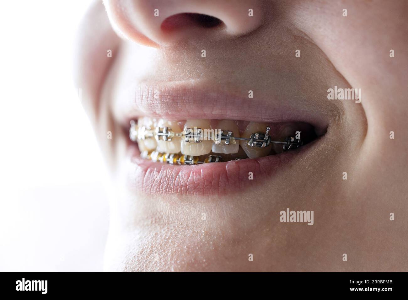metal dental braces on teeth of teenager girl closeup Stock Photo - Alamy