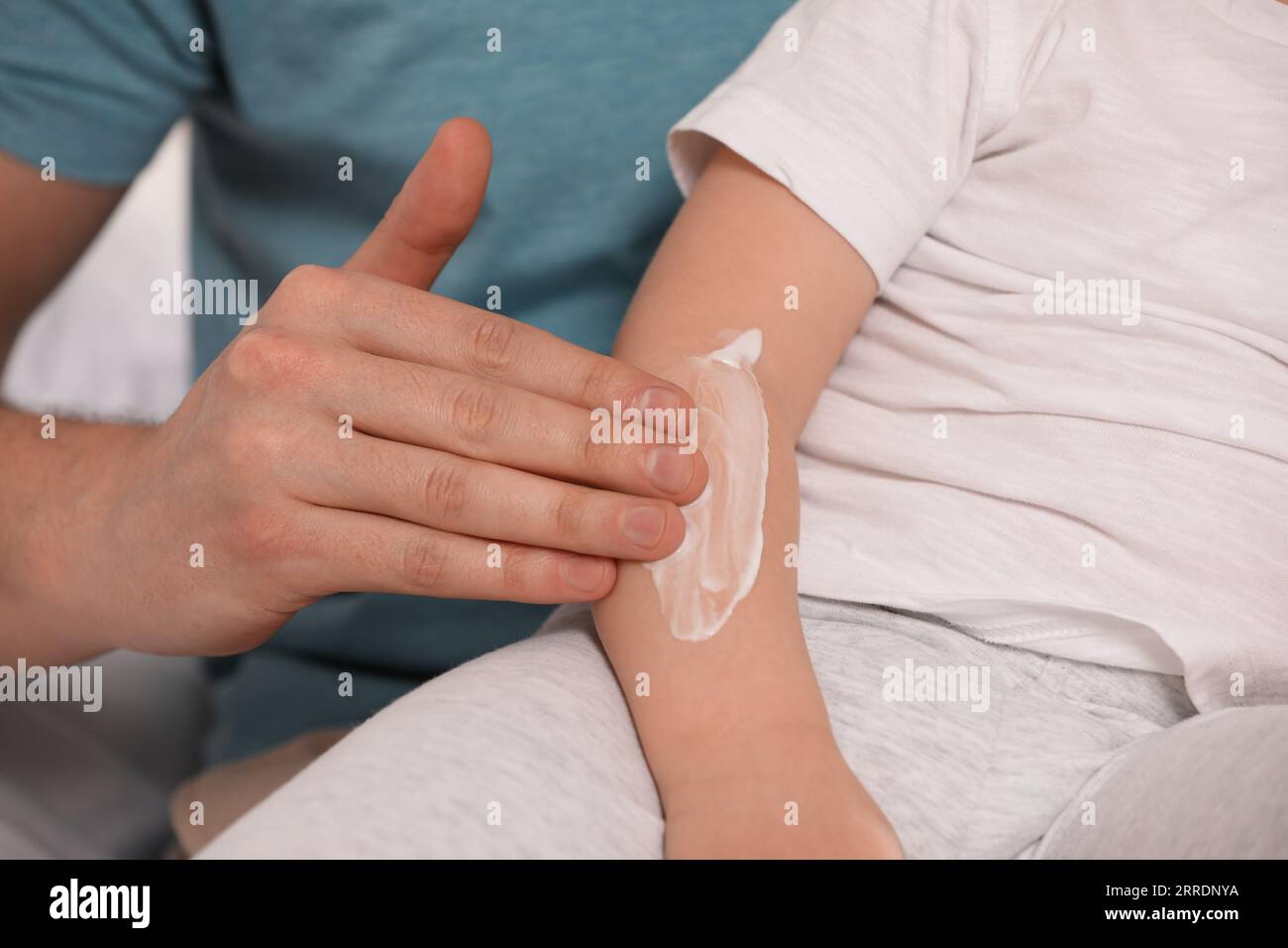 Father applying ointment onto his son`s arm, closeup Stock Photo - Alamy