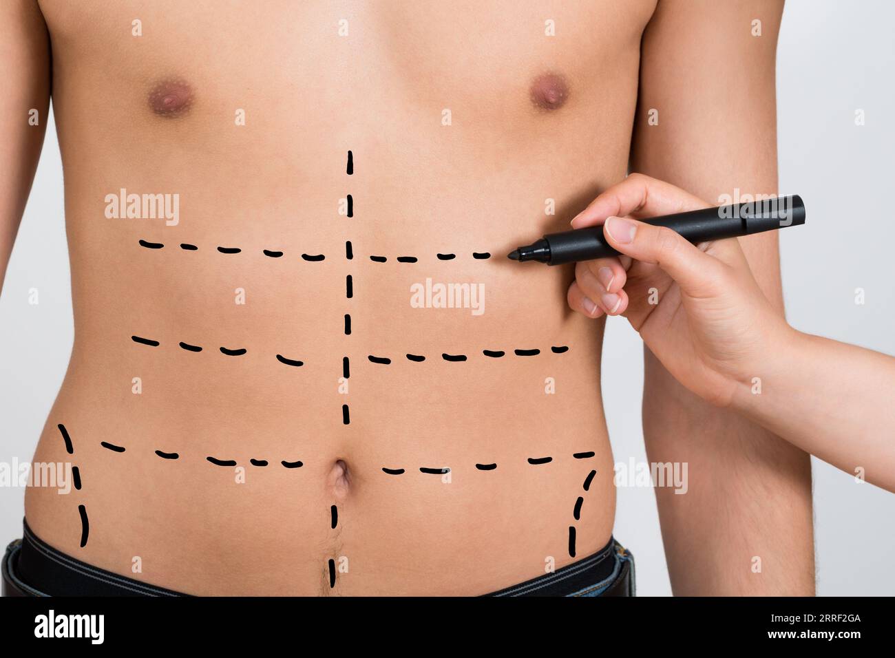 Close-up Of Person Hands Drawing Correction Lines On Abdomen Of Man Stock Photo - Alamy