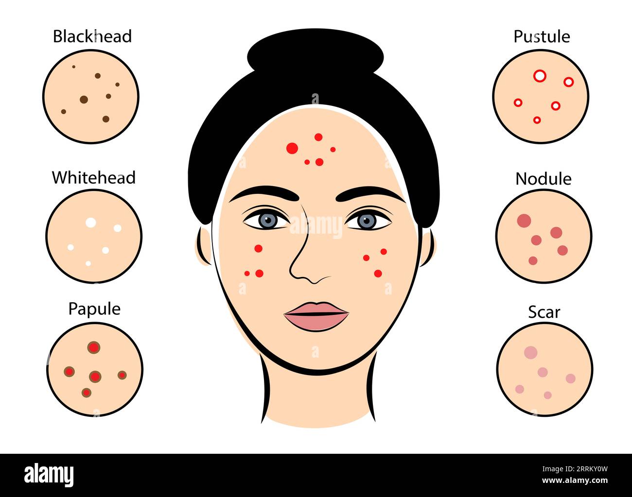 Girl With Acne On White Background Stock Vector Image And Art Alamy