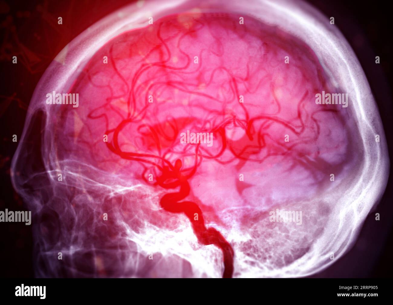 Skull lateral view fusion MRA brain image for neurology concept Stock ...