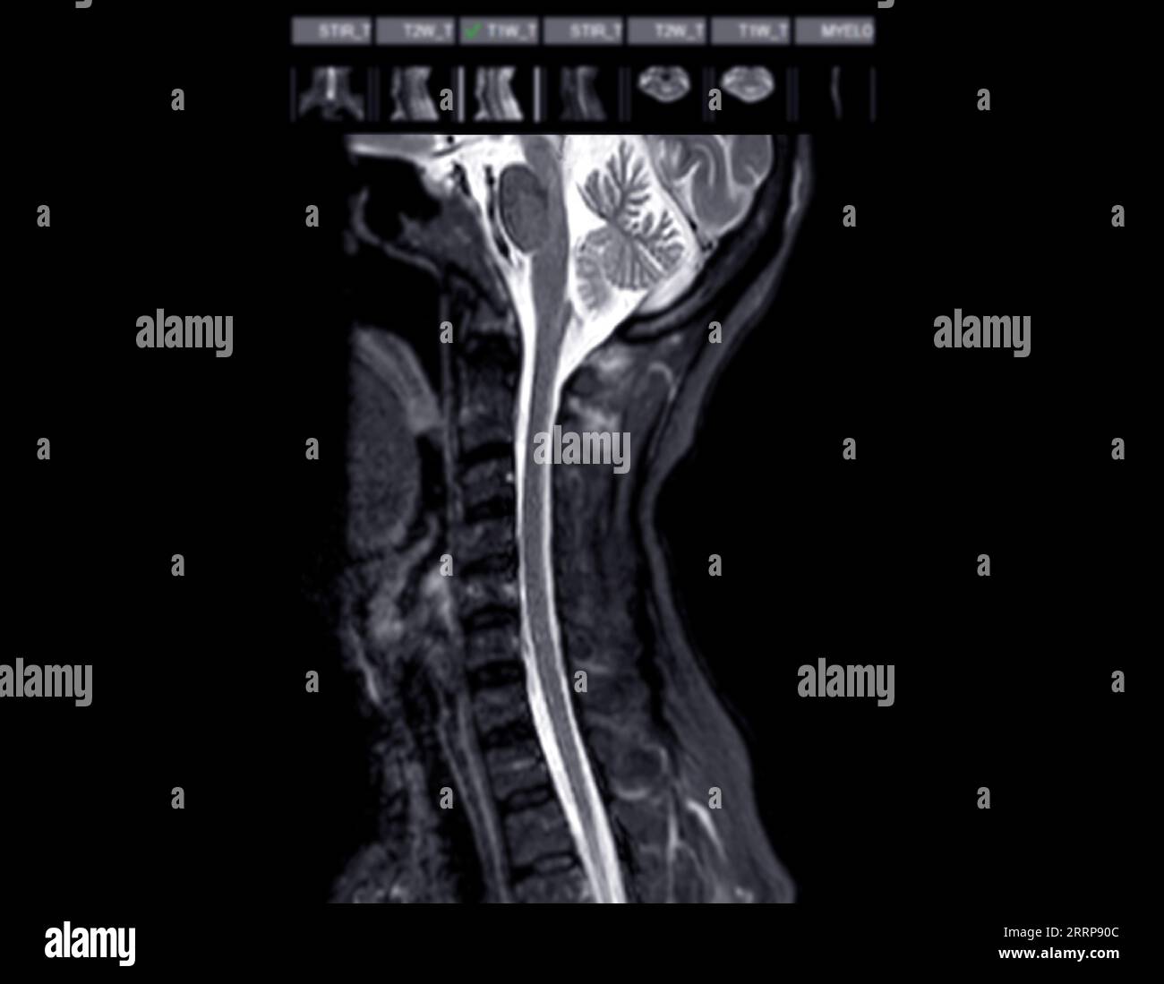 MRI of C-spine or magnetic resonance image of cervical spine sagittal ...
