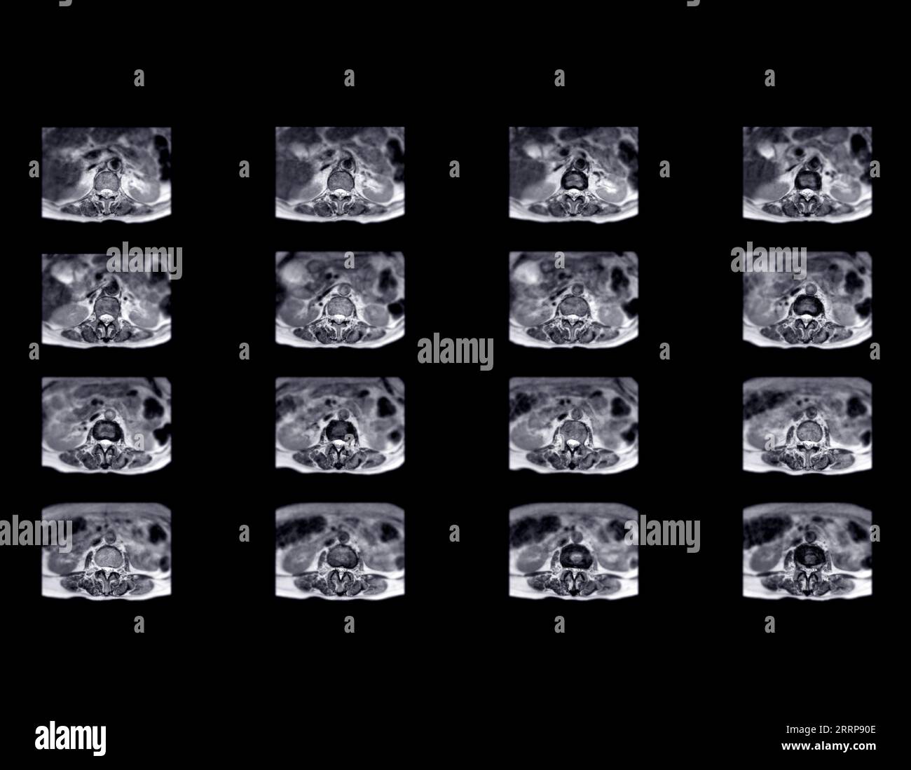 MRI L-S spine or lumbar spine for diagnosis spinal cord compression ...