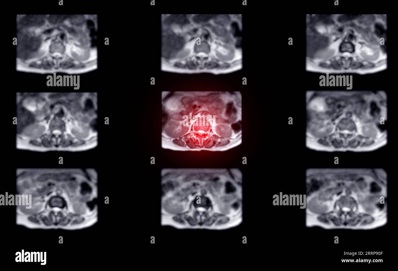 MRI L-S spine or lumbar spine for diagnosis spinal cord compression ...