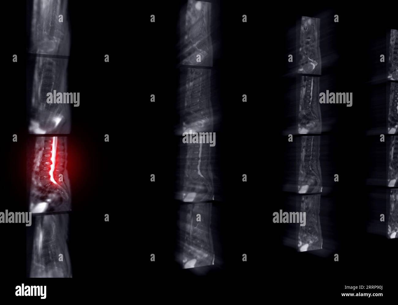 MRI L-S spine or lumbar spine for diagnosis spinal cord compression ...