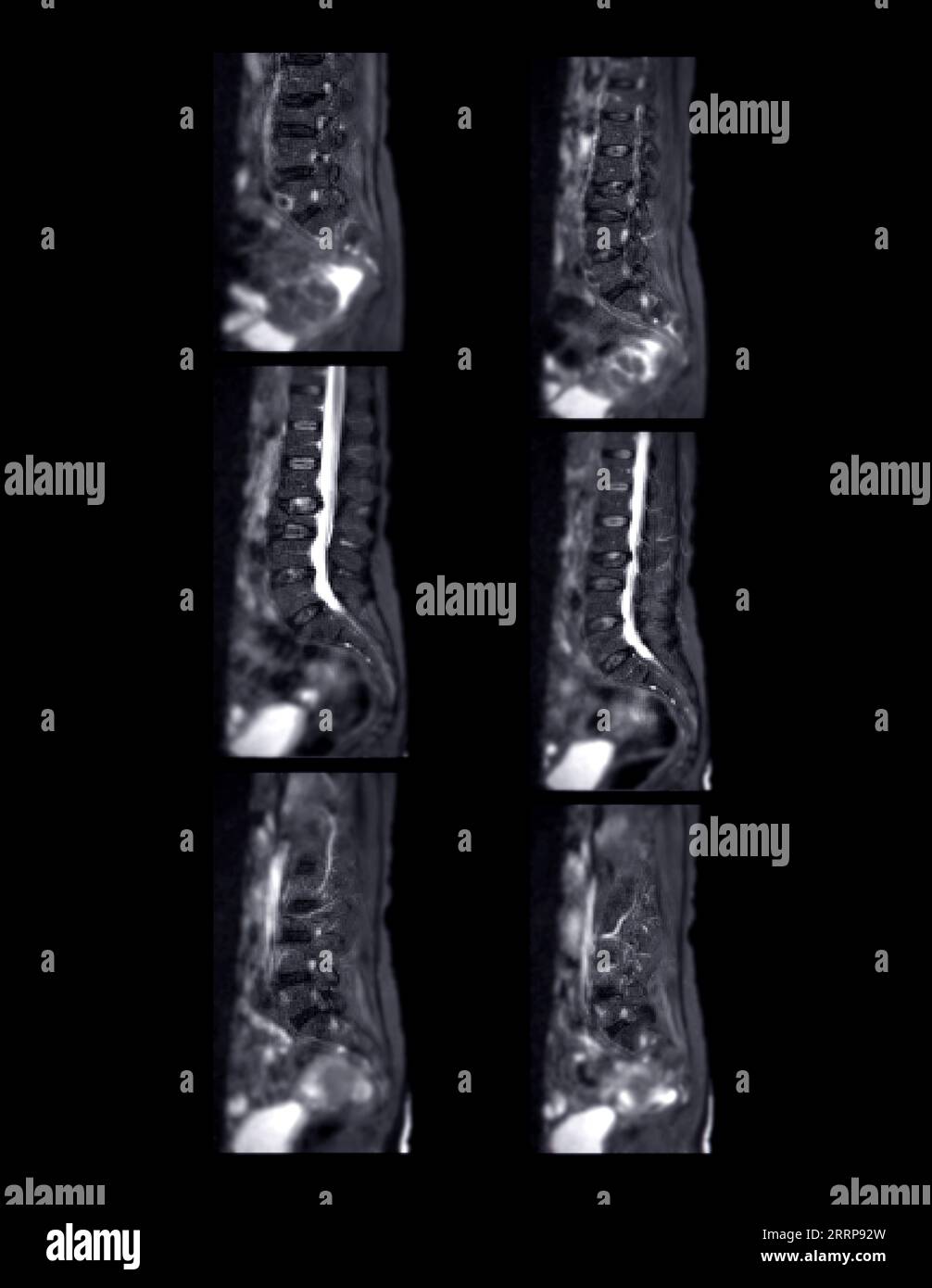 MRI L-S spine or lumbar spine for diagnosis spinal cord compression ...