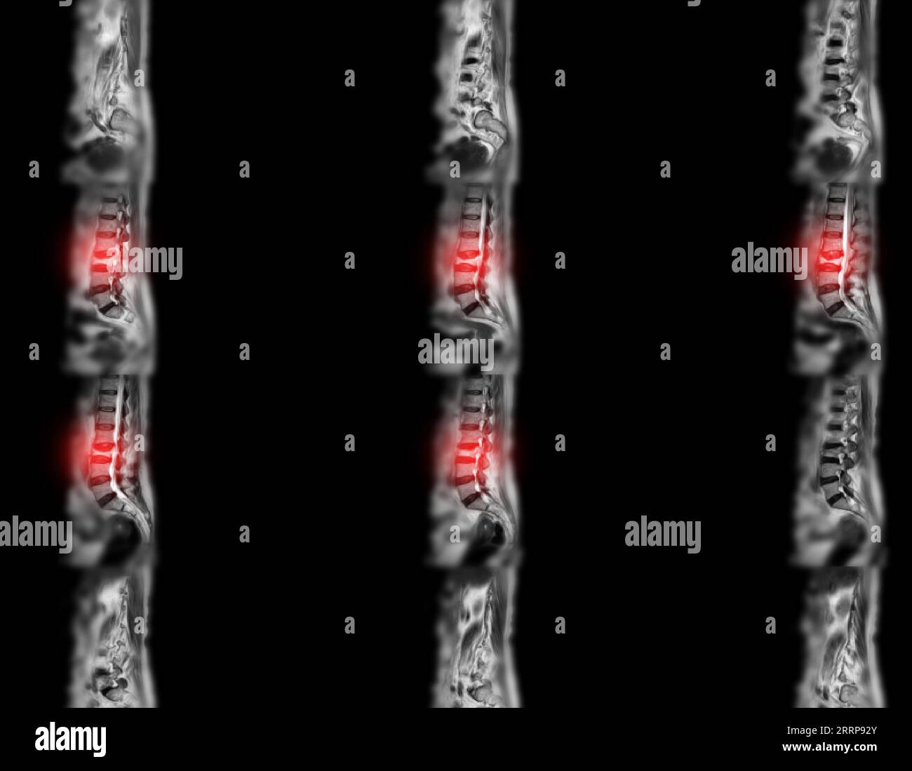 MRI L-S spine or lumbar spine for diagnosis spinal cord compression ...