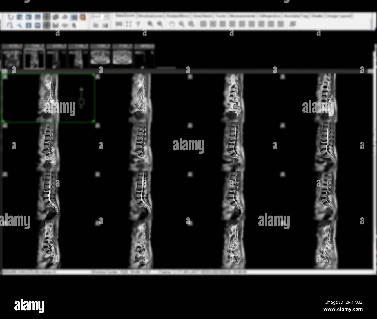 MRI L-S spine or lumbar spine sagittal view for diagnosis spinal cord ...