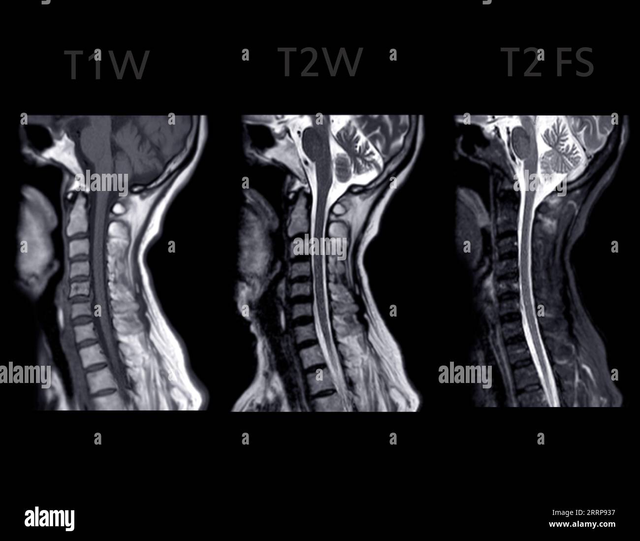 Mri Of C Spine Or Magnetic Resonance Image Of Cervical Spine Sagittal