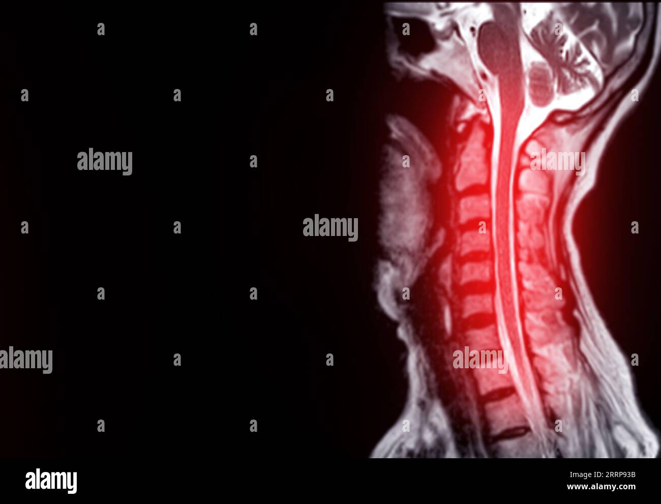 Mri Of C Spine Or Magnetic Resonance Image Of Cervical Spine Sagittal