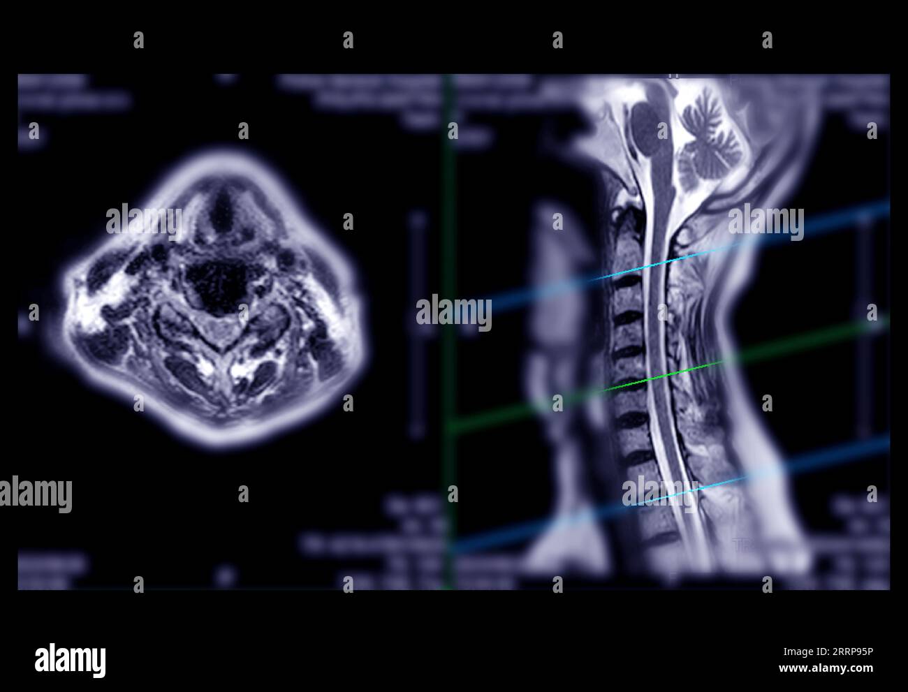 MRI of C-spine or magnetic resonance image of cervical spine sagittal ...