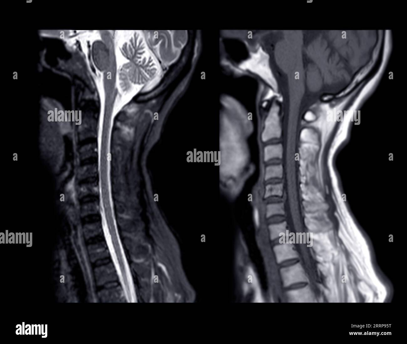 MRI of C-spine or magnetic resonance image of cervical spine sagittal ...
