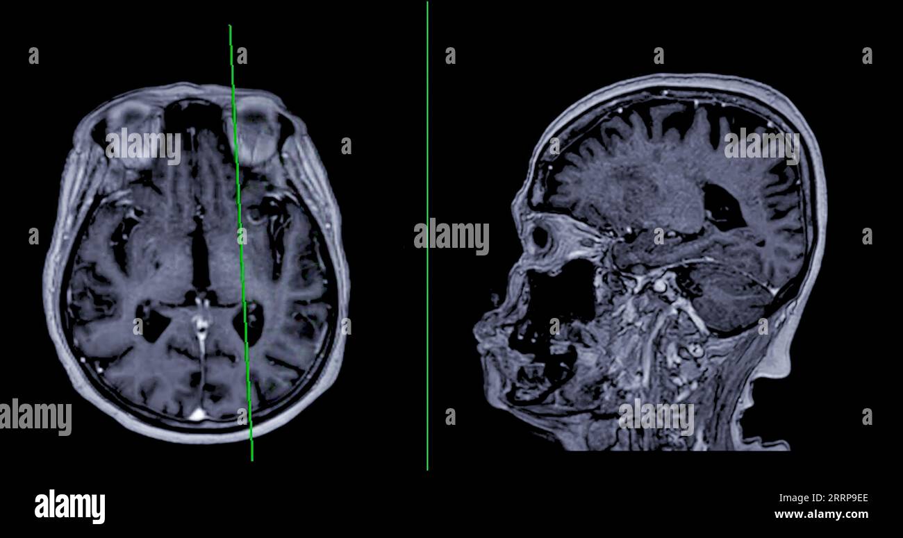 MRI brain scan Axial and sagittal view with reference line for detect Brain diseases sush as ...