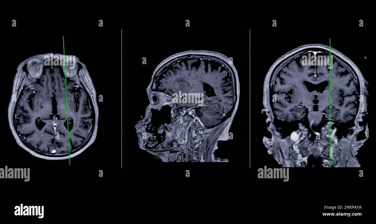 MRI brain scan Axial , Coronal and sagittal view with referance line ...