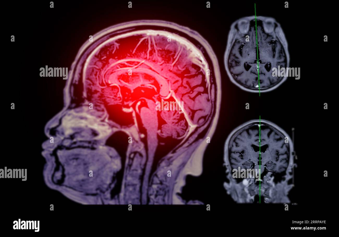 What Can Mri Brain Detect at Rocio Wilds blog What Can Mri Brain Detect at Rocio Wilds blog