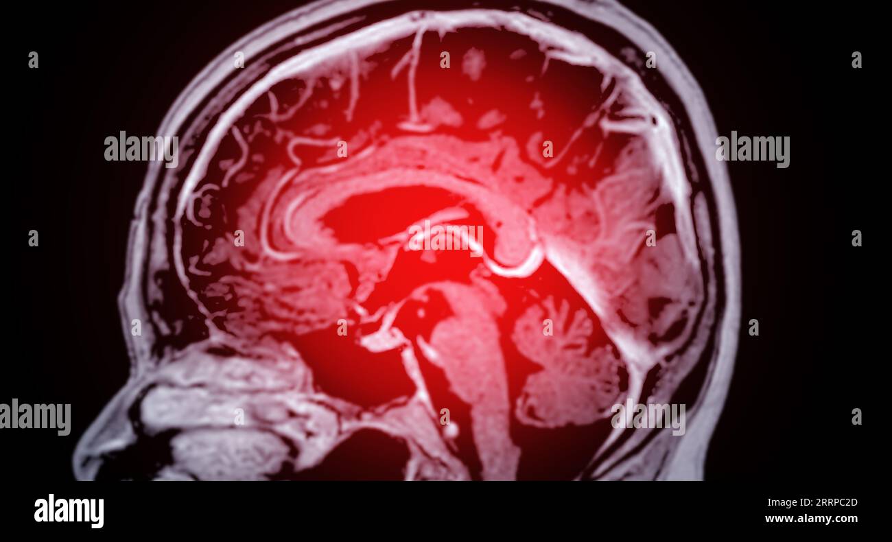 MRI brain scan for detect Brain diseases sush as stroke disease, Brain ...
