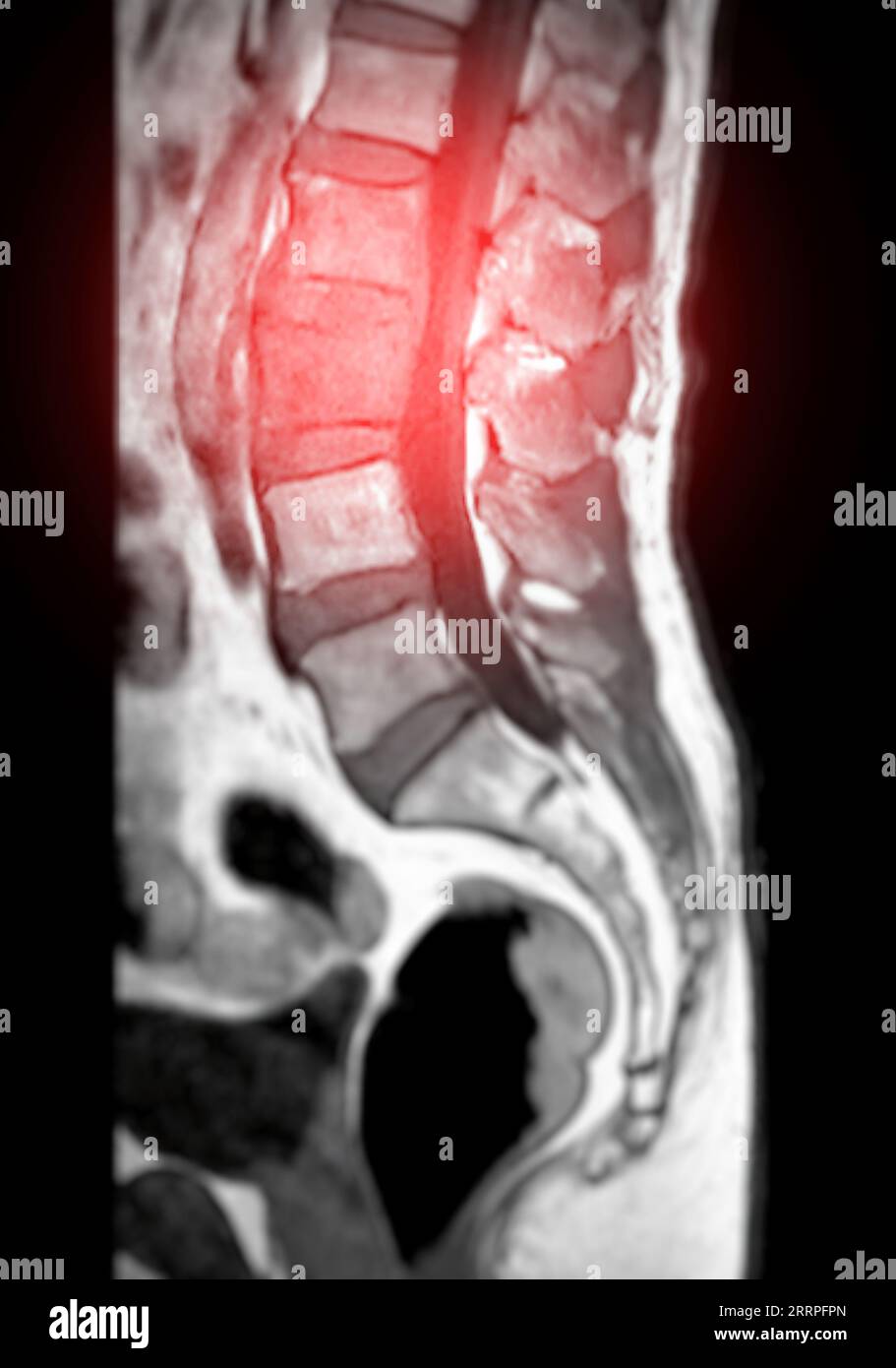 Compressed Spine Mri