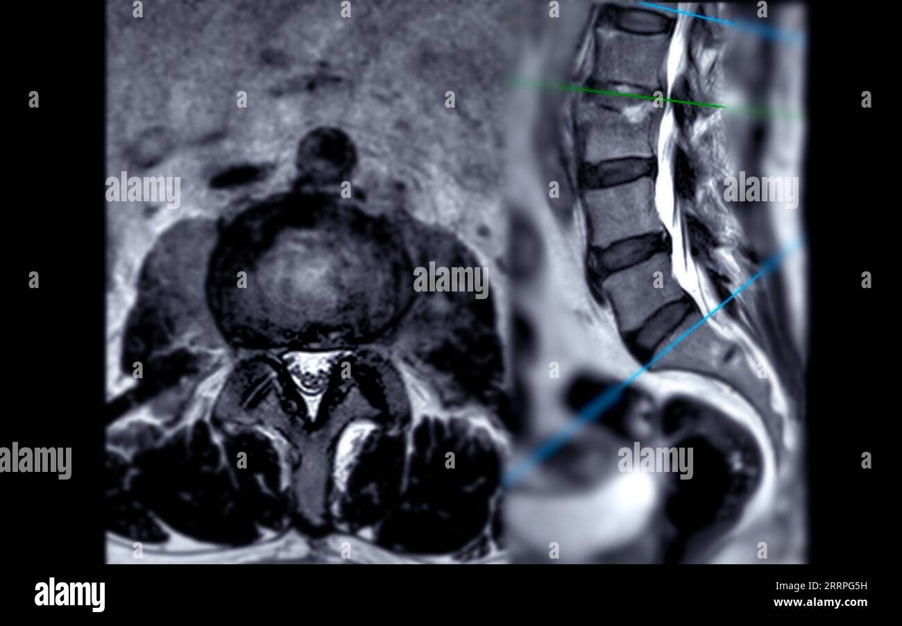 MRI L-S spine or lumbar spine Axial and sagittal T2 technique with ...
