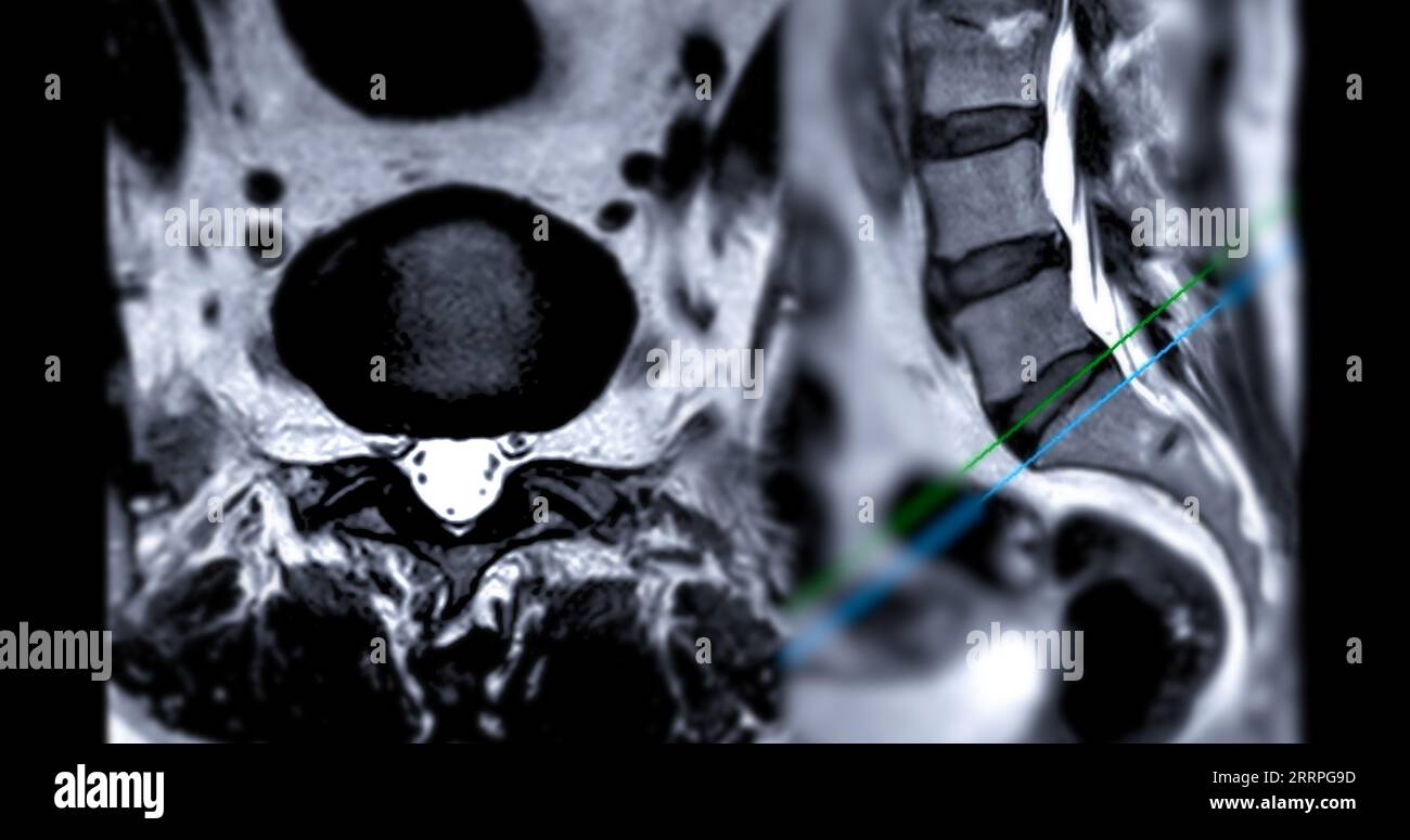MRI L-S spine or lumbar spine Axial and sagittal T2 technique with ...