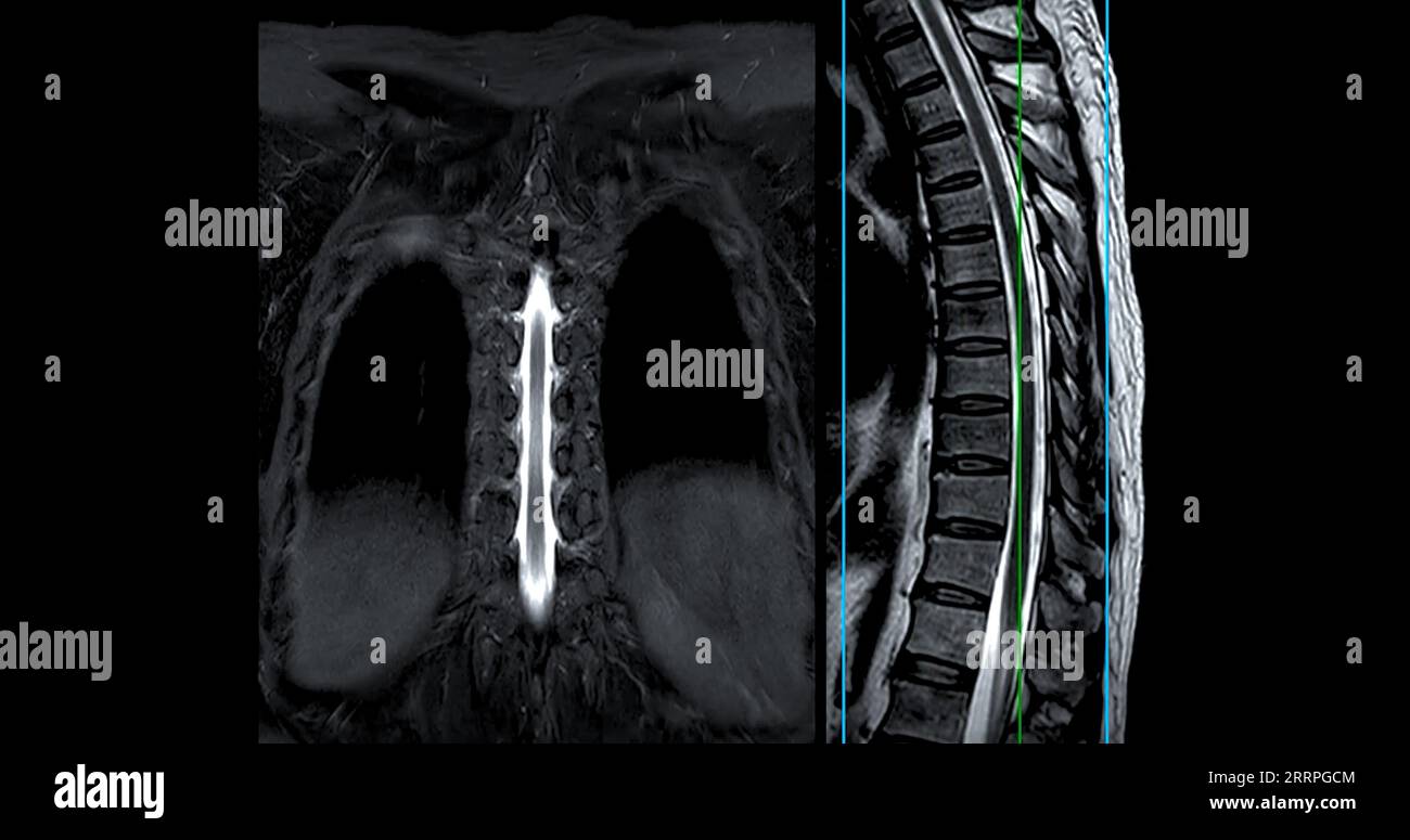 MRI T-L spine or Thoracosacral spine Coronal and sagittal T2 technique with reference line for ...