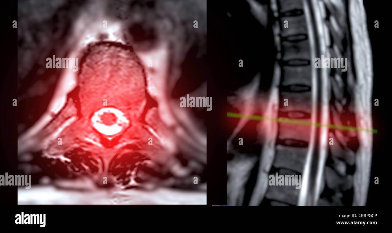 Mri t l spine hi-res stock photography and images - Alamy